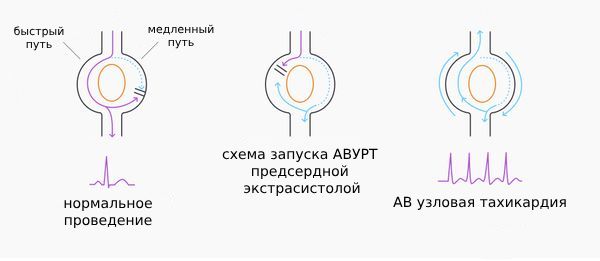 АВ-узловая реципрокная тахикардия (АВУРТ): причины, симптомы и лечение ...