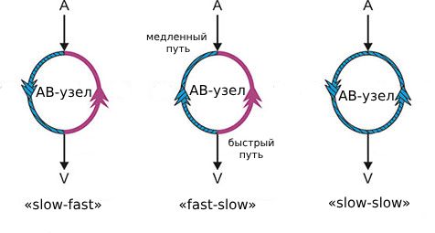 АВ-узловая реципрокная тахикардия (АВУРТ): причины, симптомы и лечение ...