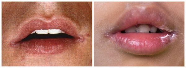 Расскажем о Candida robusta что это такое